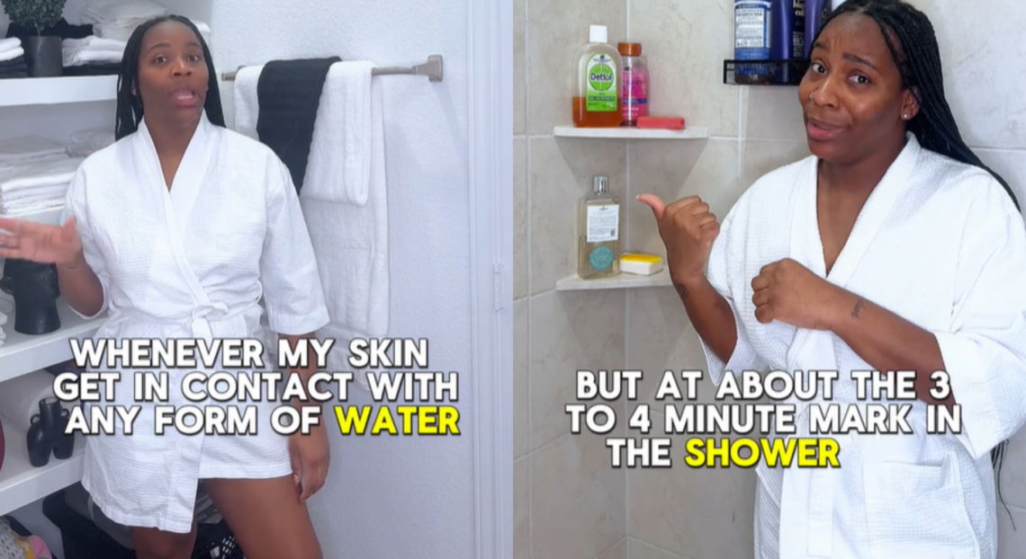 Woman severely allergic to water details her excruciatingly painful ...