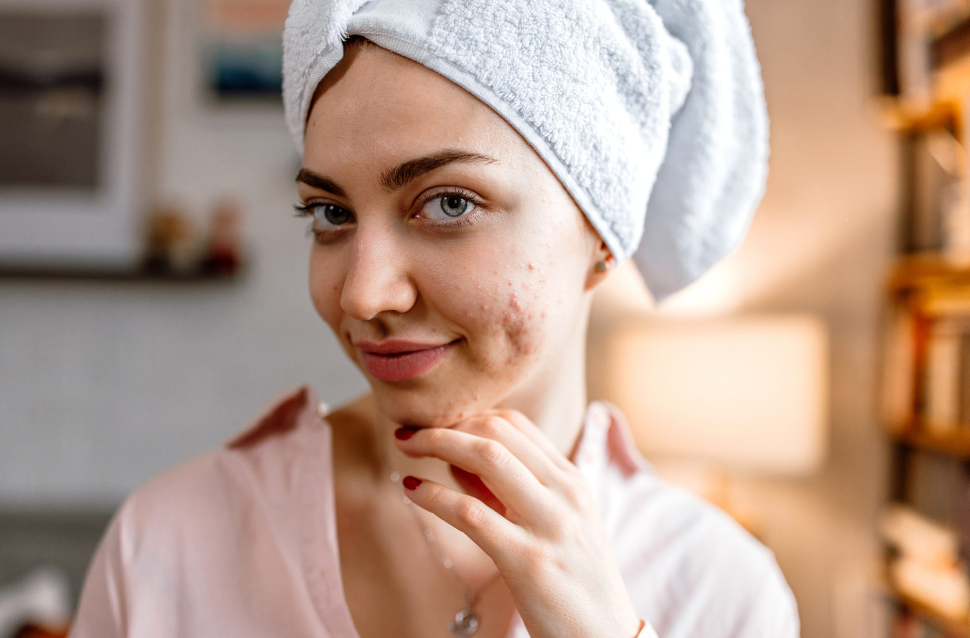 New report finds adult acne is far more common than you think