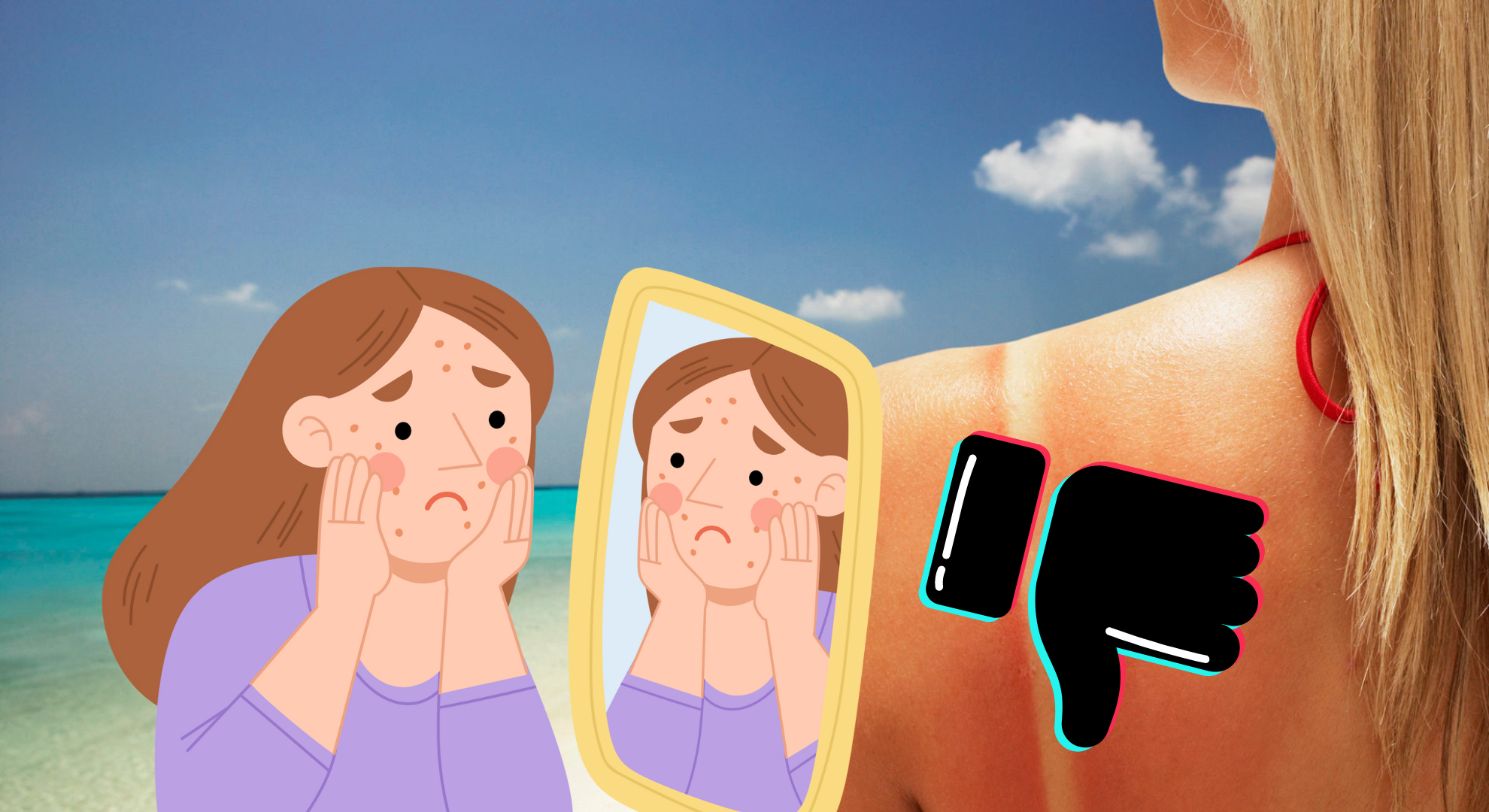'Sunburning' trend for treating acne poses 'immediate danger' of ...