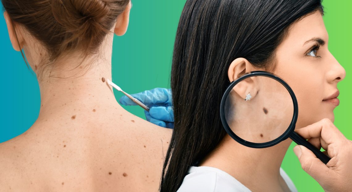 3 common skin cancer signs that will help you 'catch it early ...