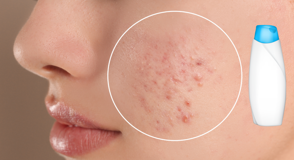 Dermatologist-approved hack to treat fungal acne with Head & Shoulders ...