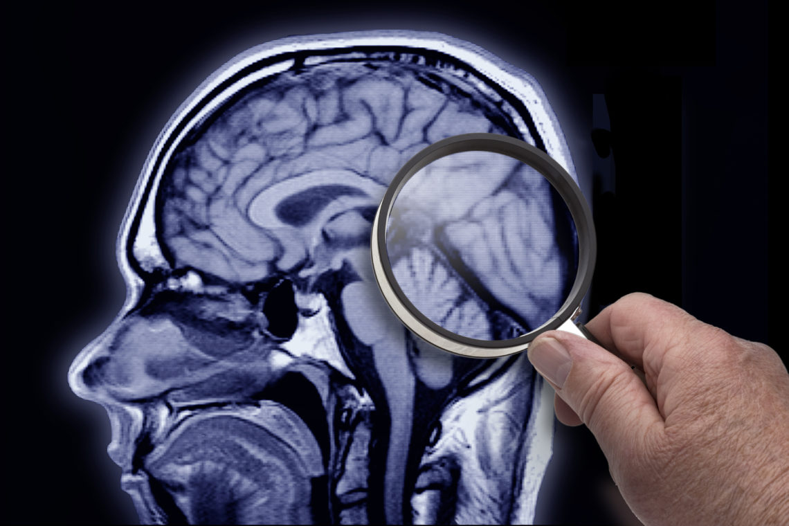 Common stomach bug may 'moderately' increase the risk of Alzheimer's ...