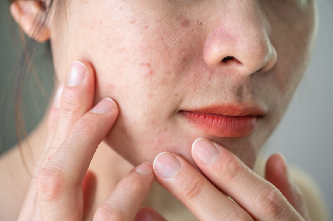 Tiny bugs are living on your face, and there's nothing you can do about it